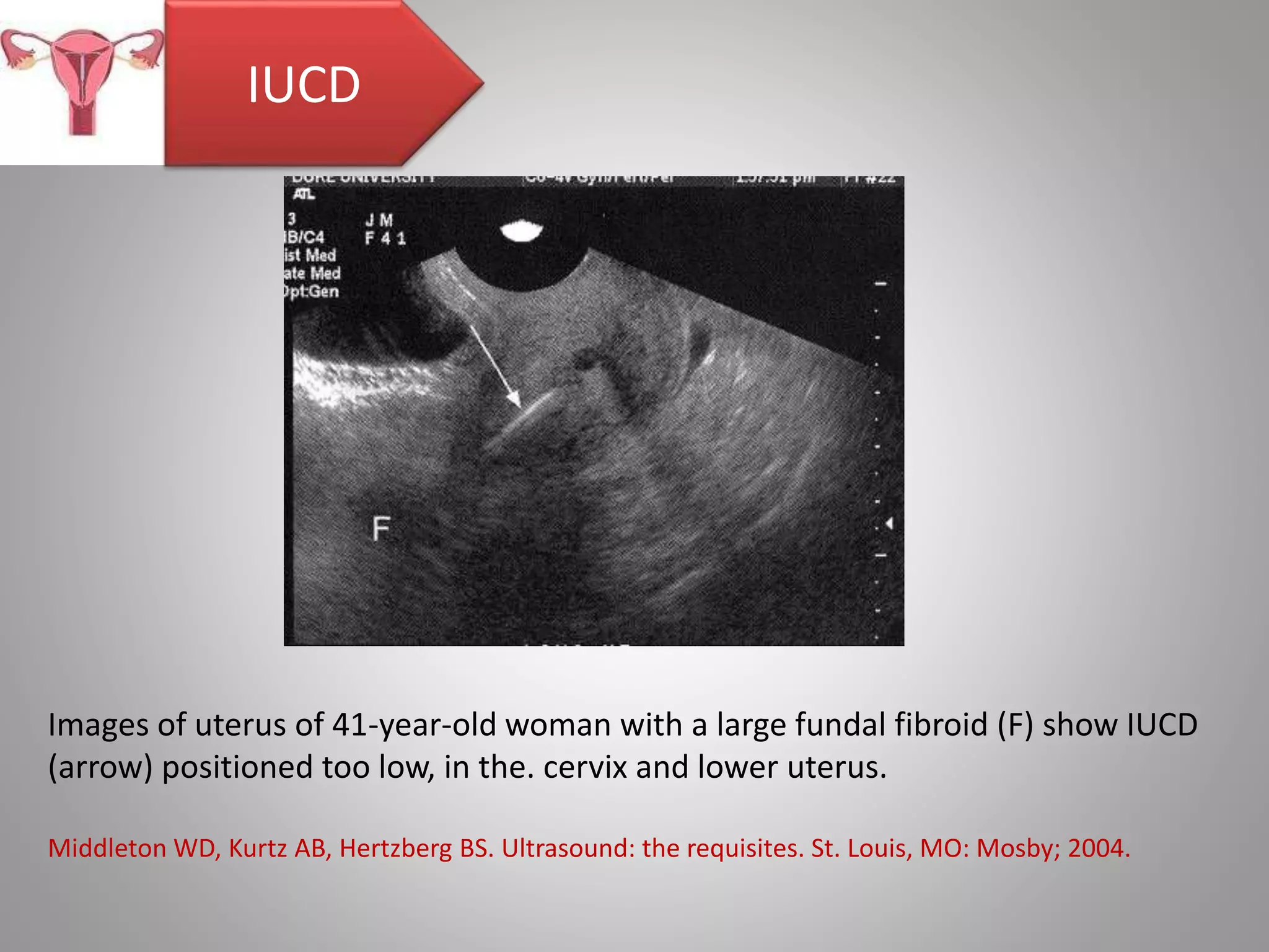 Role of Ultrasound in the assessment of Intrauterine Contraceptive ...