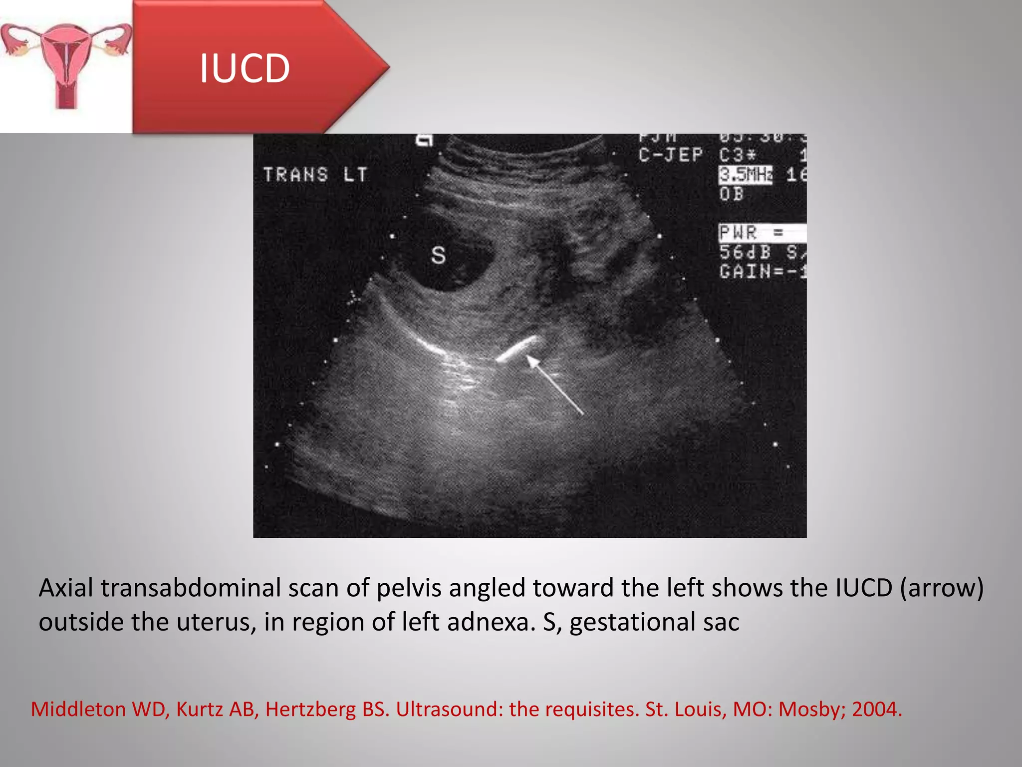 Role of Ultrasound in the assessment of Intrauterine Contraceptive ...