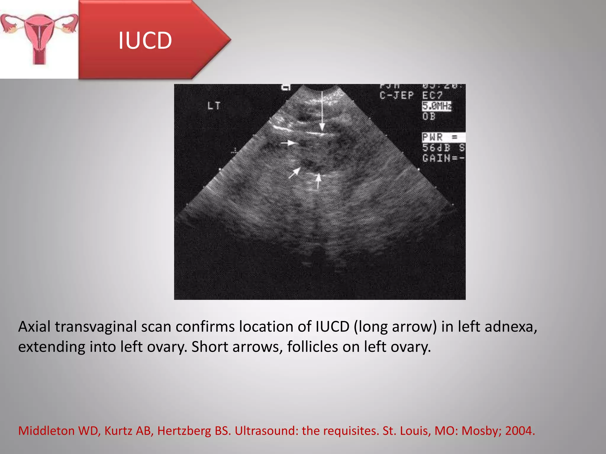 Role of Ultrasound in the assessment of Intrauterine Contraceptive ...