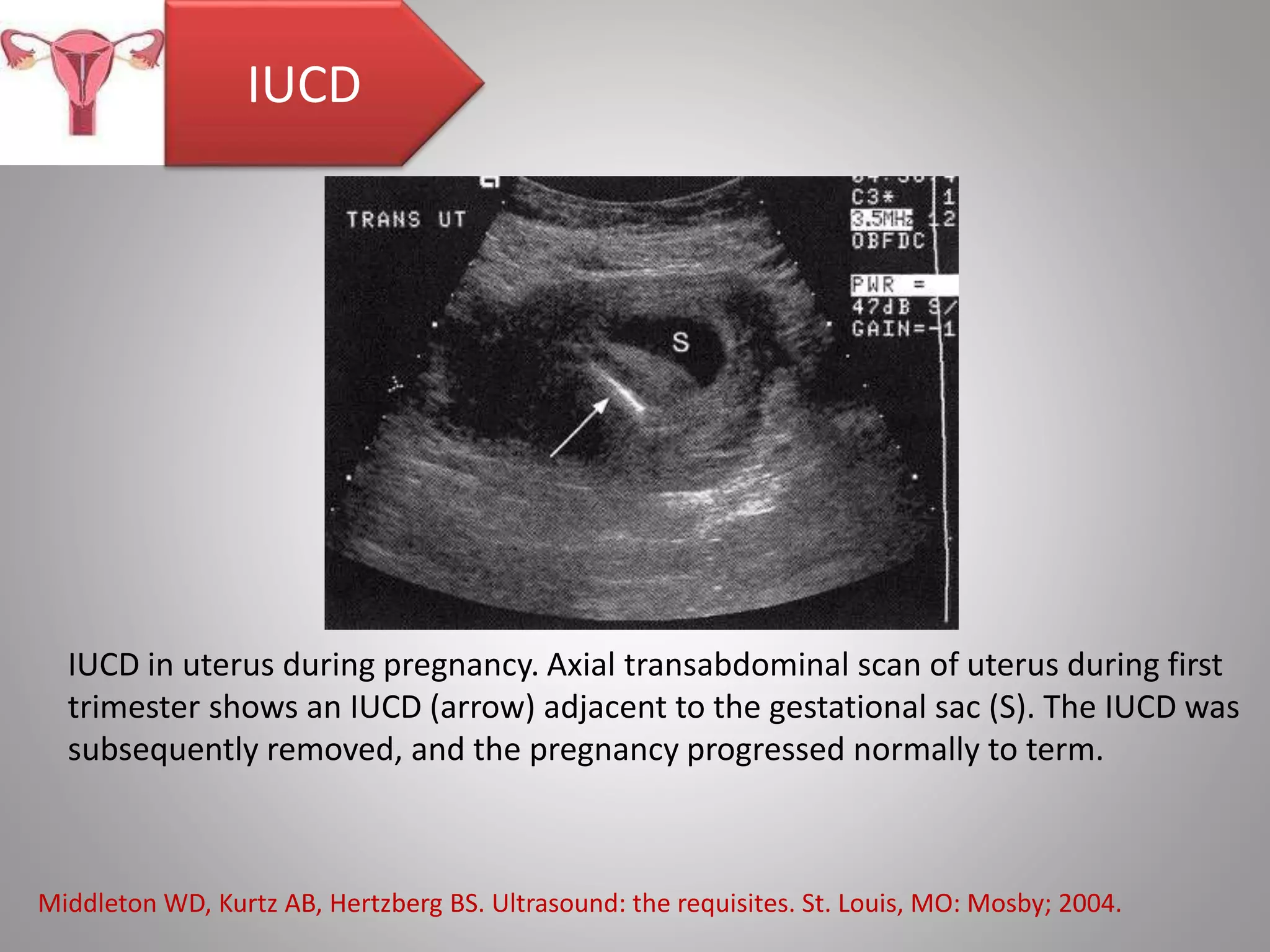Role of Ultrasound in the assessment of Intrauterine Contraceptive ...