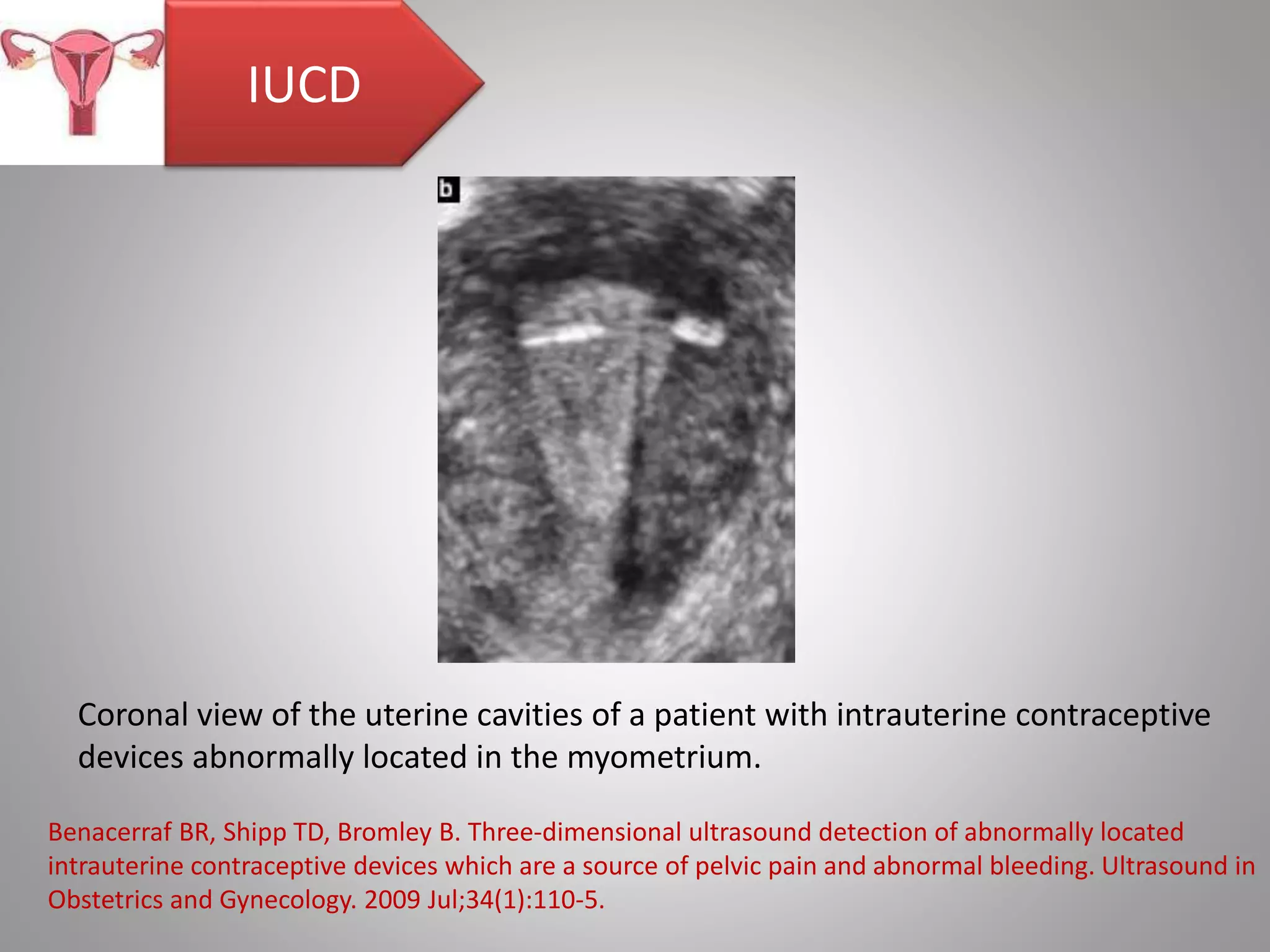 Role of Ultrasound in the assessment of Intrauterine Contraceptive ...