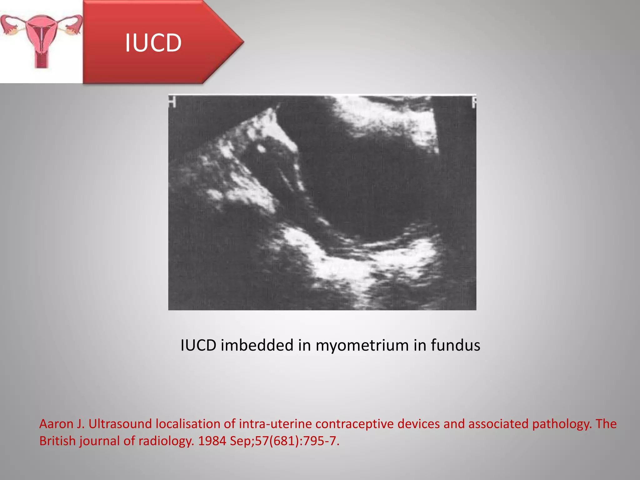 Role of Ultrasound in the assessment of Intrauterine Contraceptive ...