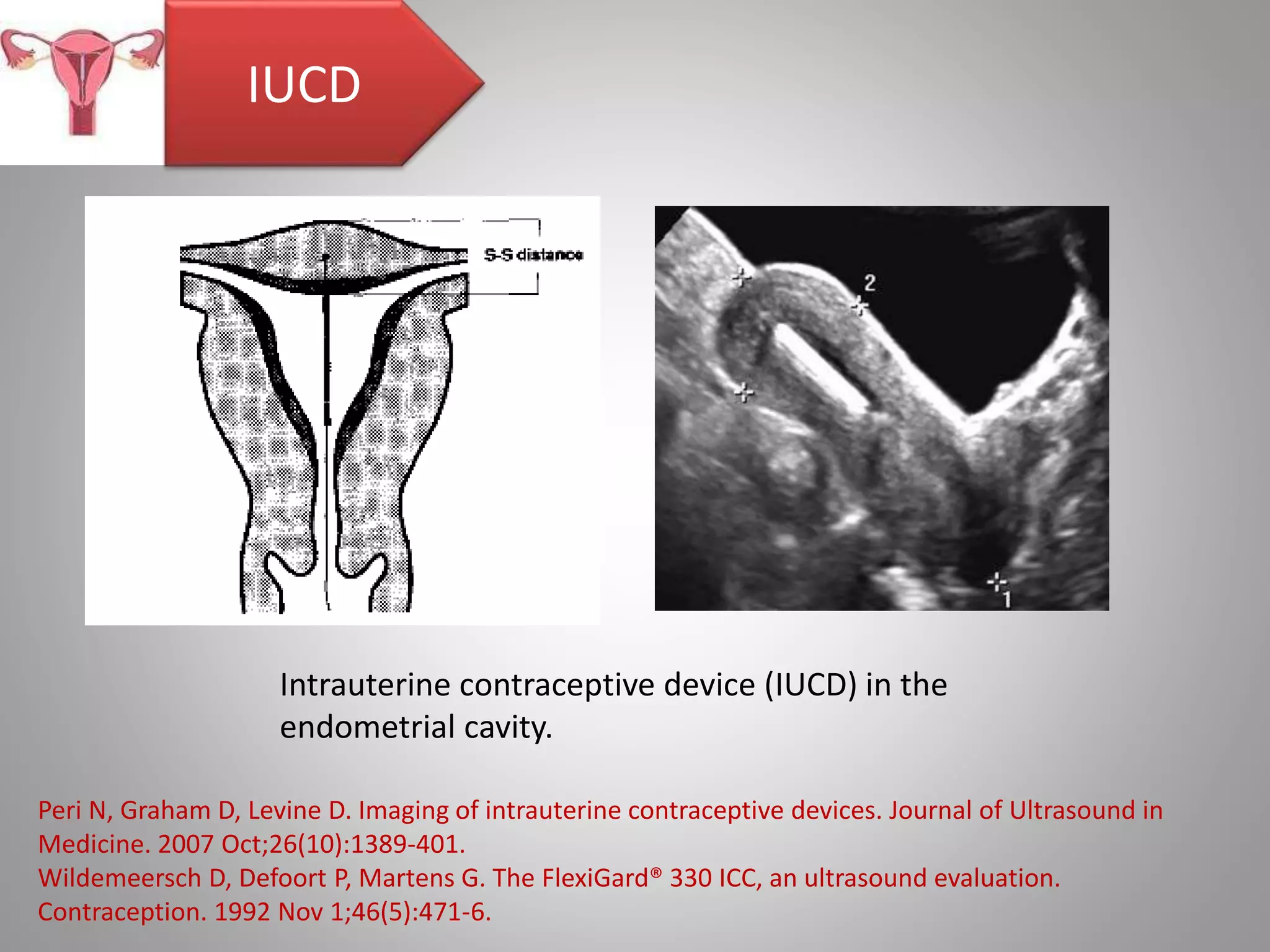 Role of Ultrasound in the assessment of Intrauterine Contraceptive ...