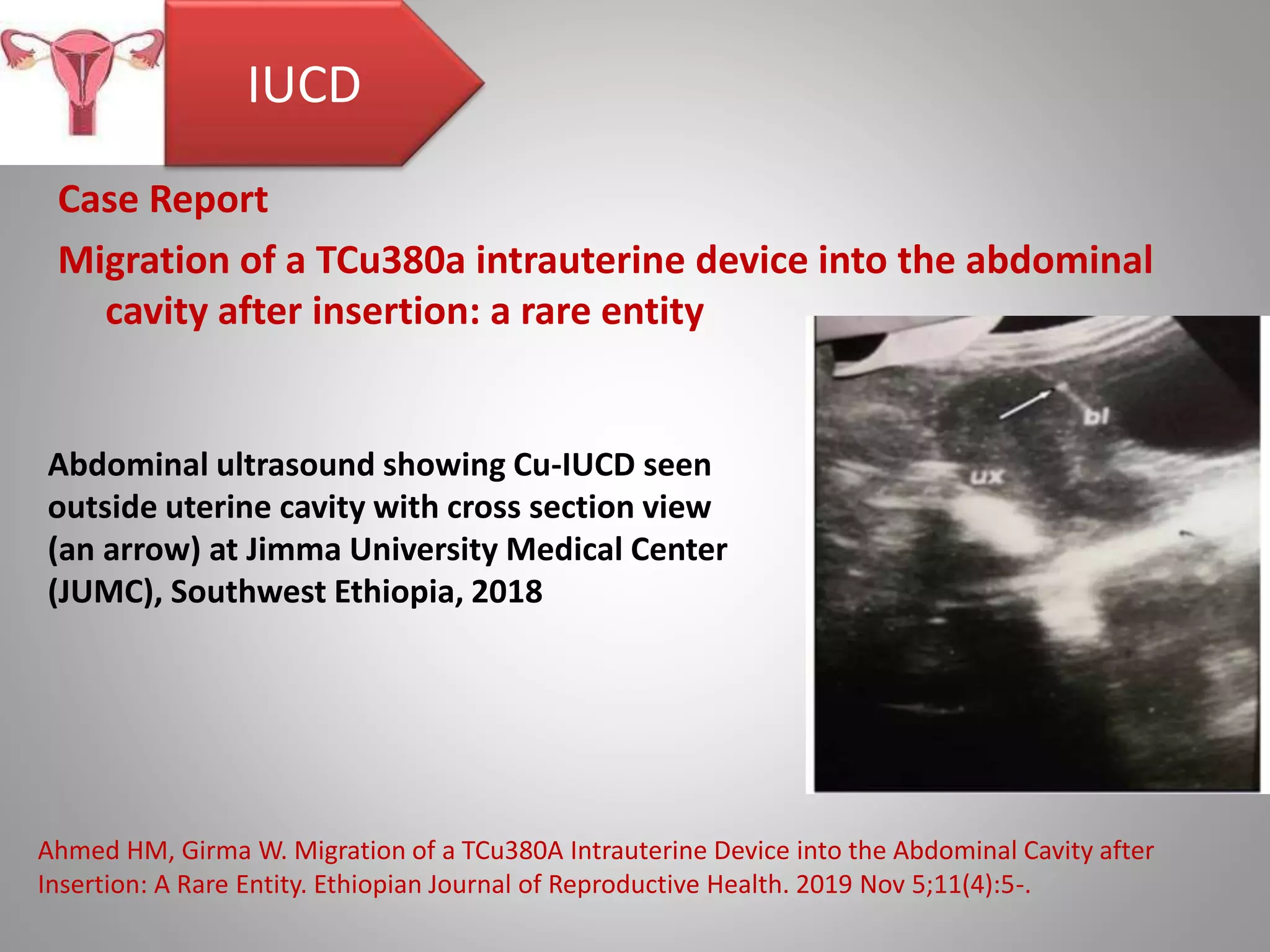 Role of Ultrasound in the assessment of Intrauterine Contraceptive ...
