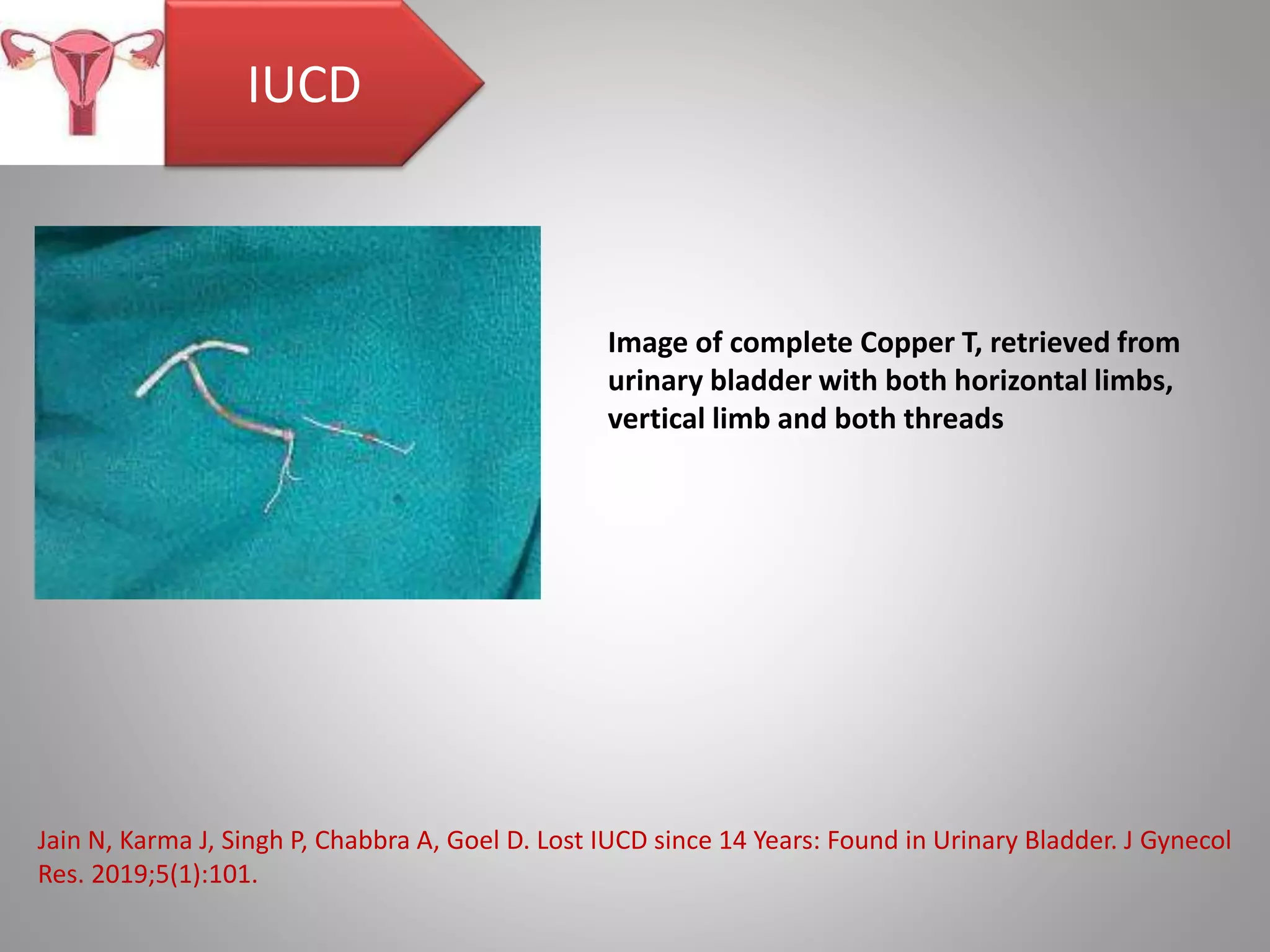 Role of Ultrasound in the assessment of Intrauterine Contraceptive ...