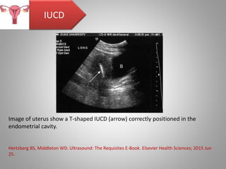 Role of Ultrasound in the assessment of Intrauterine Contraceptive ...