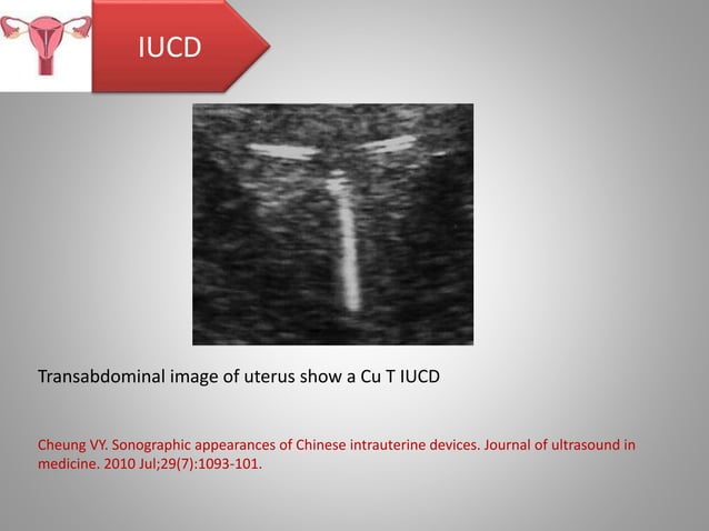 Role of Ultrasound in the assessment of Intrauterine Contraceptive ...