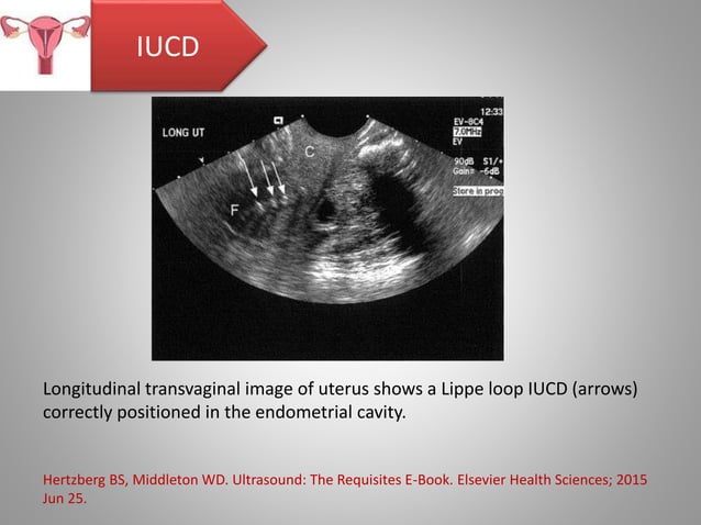 Role of Ultrasound in the assessment of Intrauterine Contraceptive ...