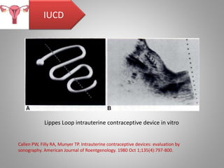 Role of Ultrasound in the assessment of Intrauterine Contraceptive ...