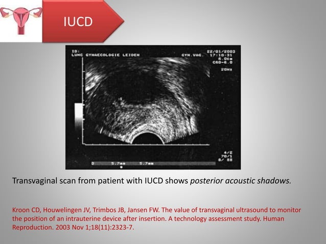 Role of Ultrasound in the assessment of Intrauterine Contraceptive ...