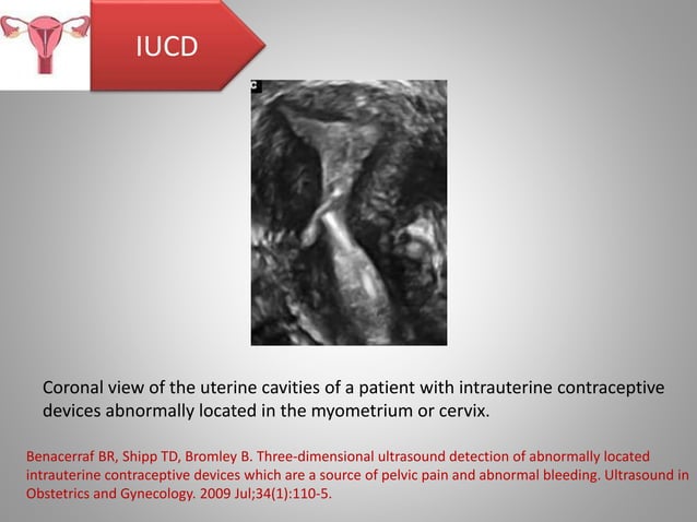 Role of Ultrasound in the assessment of Intrauterine Contraceptive ...