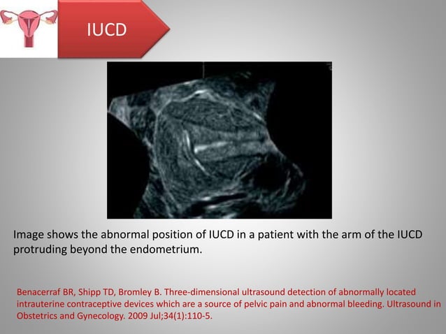 Role of Ultrasound in the assessment of Intrauterine Contraceptive ...
