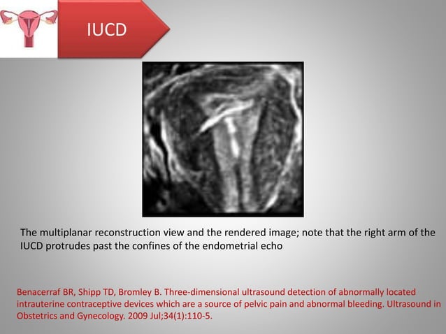 Role of Ultrasound in the assessment of Intrauterine Contraceptive ...