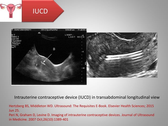 Role of Ultrasound in the assessment of Intrauterine Contraceptive ...