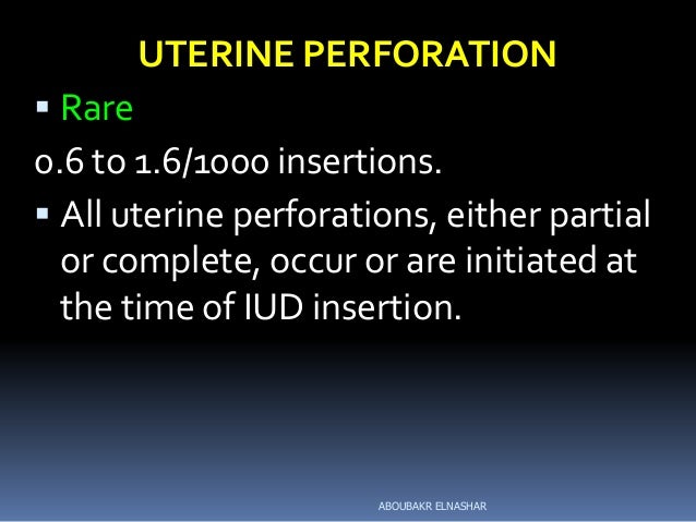 IUCD: Uterine perforation