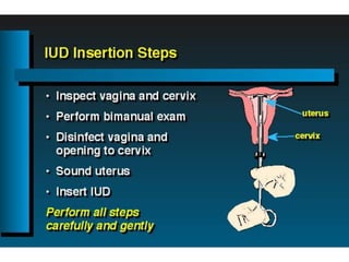 Iud Insertion Steps