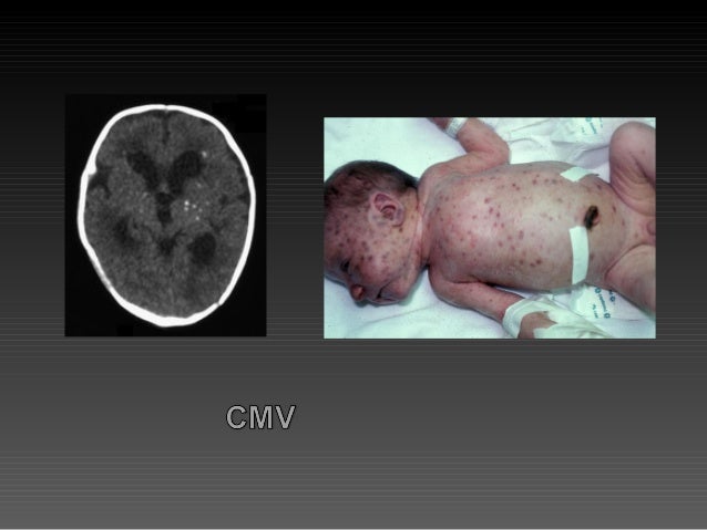 Babies Born With Iud Embedded