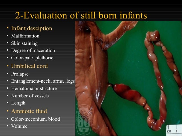 Babies Born With Iud Embedded