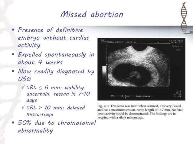 Complete Miscarriage At 14 Weeks