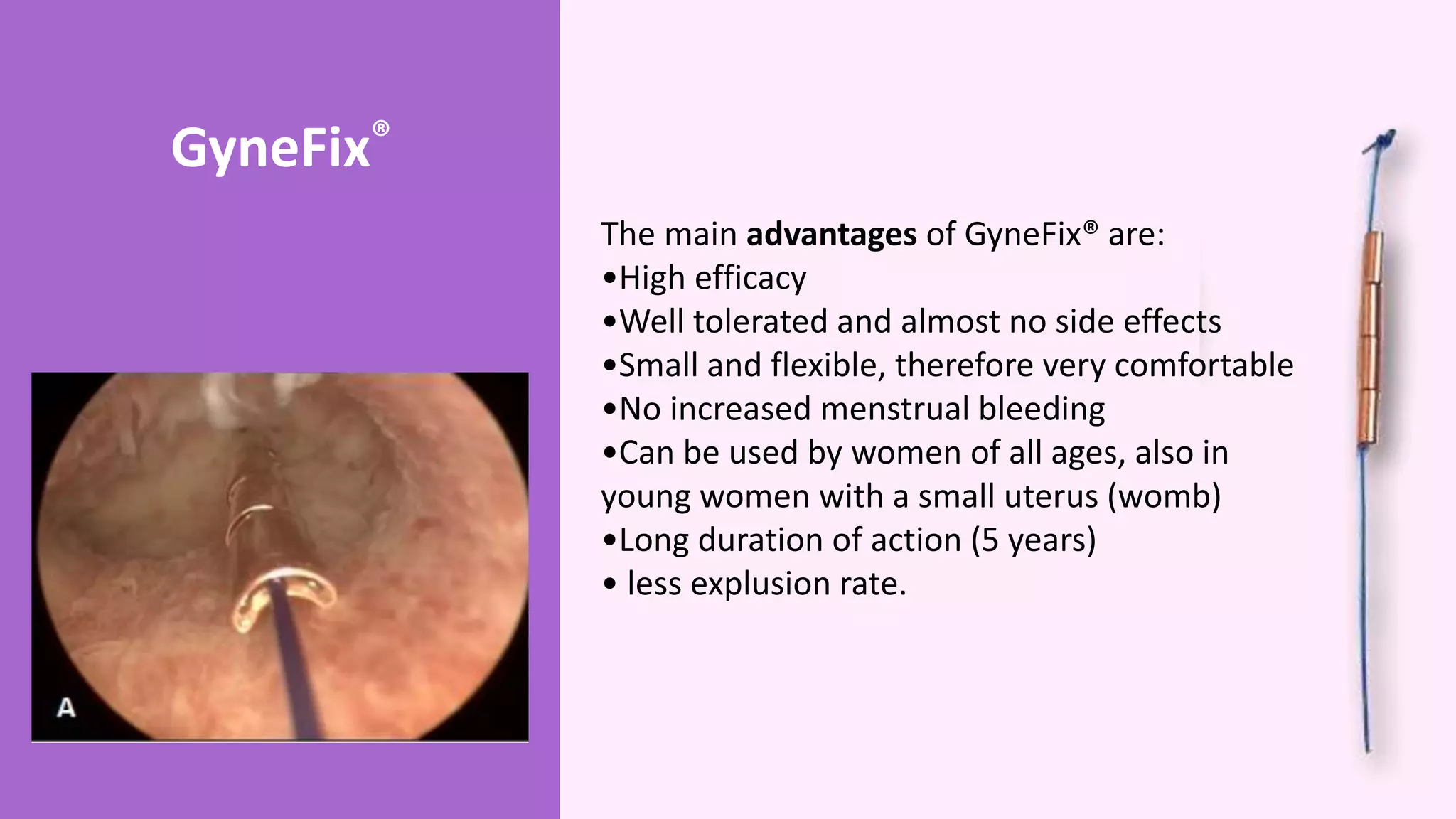 IUD.pptx