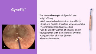 IUD.pptx | Birth Control | Reproductive Health