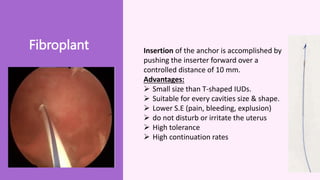 IUD.pptx | Birth Control | Reproductive Health