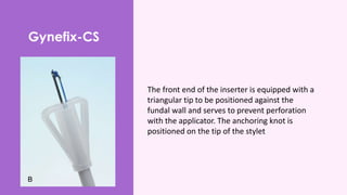 IUD.pptx | Birth Control | Reproductive Health