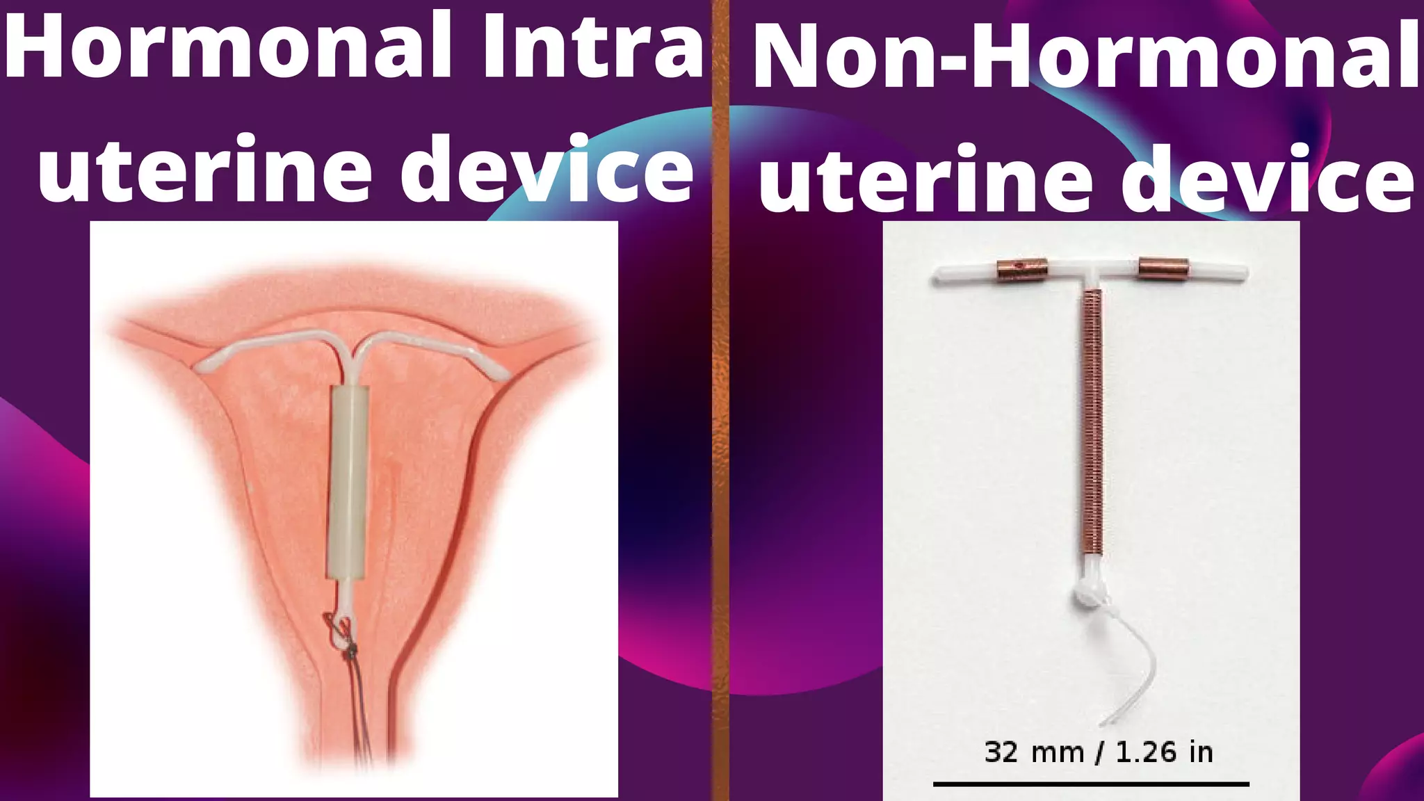 IUD- Drug Delivery System .pdf