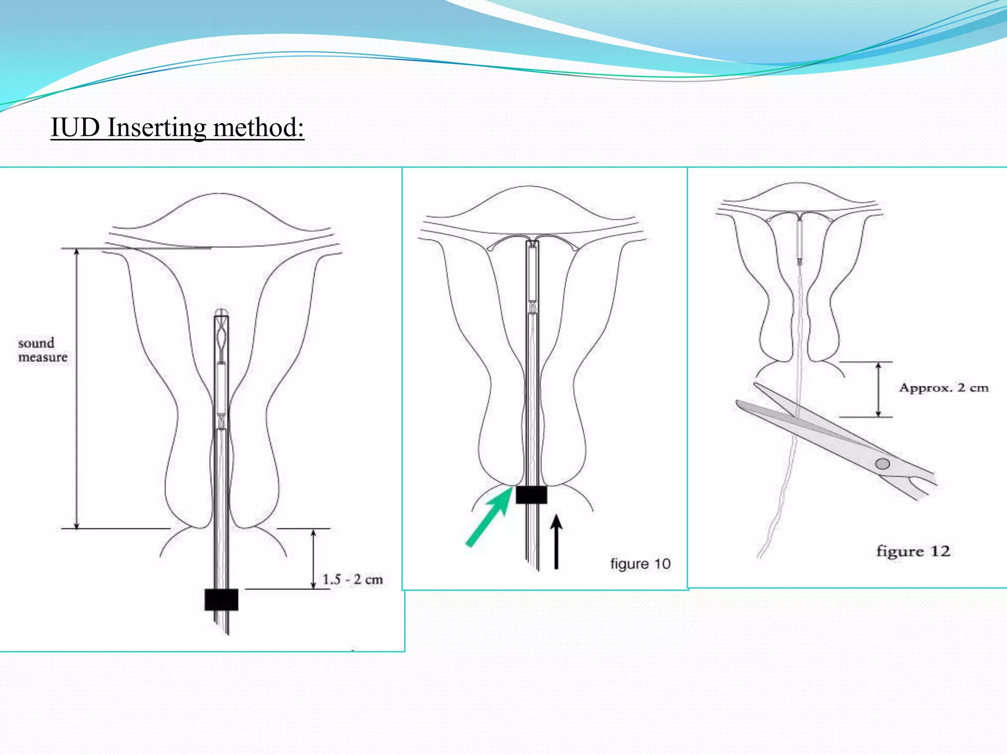 Intra Uterine Devices | PPTX