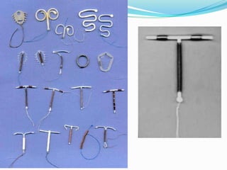 Intra Uterine Devices | PPTX