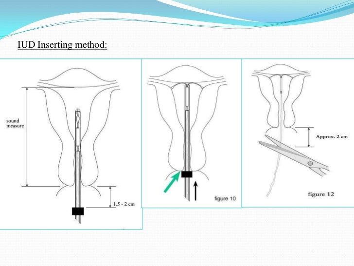 Intra Uterine Devices