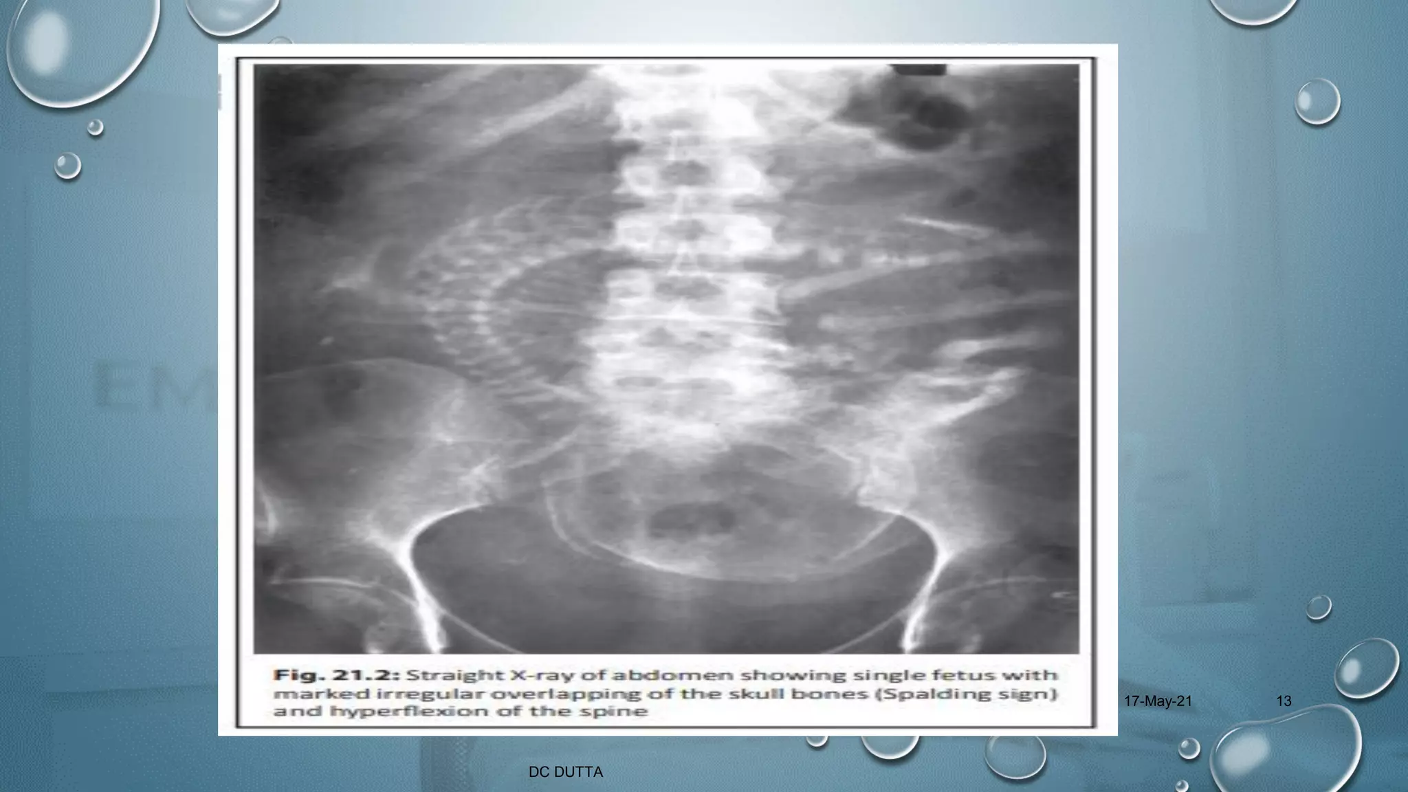 Intrauterine Fetal Death (IUFD) -EBM.pdf