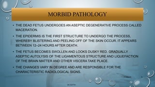 Intrauterine Fetal Death (IUFD) -EBM.pdf