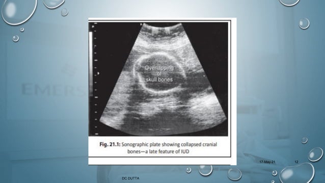 Intrauterine Fetal Death (IUFD) -EBM.pdf