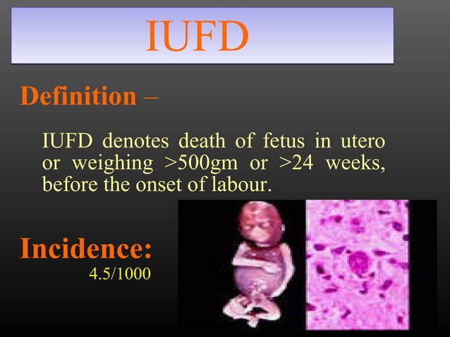 Iufd by dr shabnam | PPT