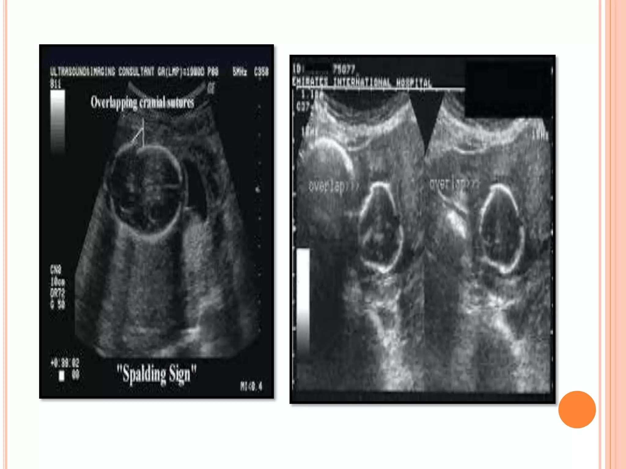 IUFD(INTRA UTERINE FETAL DEATH).pptx