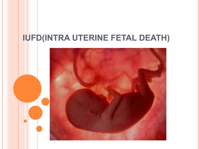 IUFD(INTRA UTERINE FETAL DEATH).pptx | Pregnancy | Reproductive Health