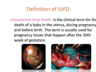 Intrauterine Fetal Death (IUFD),(Kurdistan) | PPTX