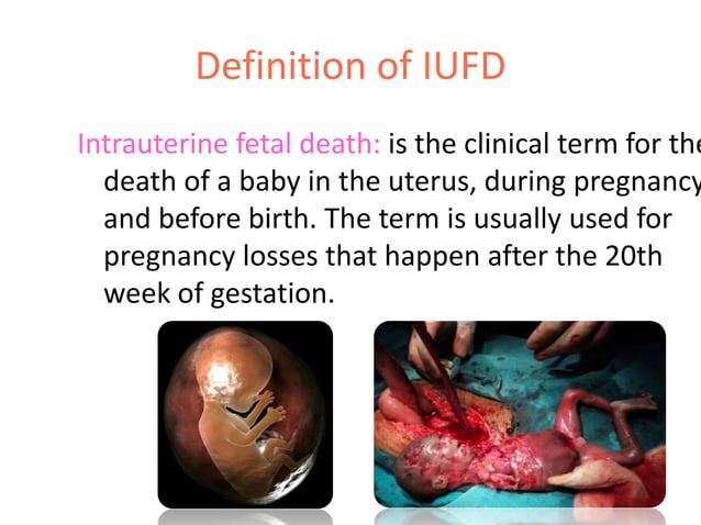Intrauterine Fetal Death (IUFD),(Kurdistan) | PPTX