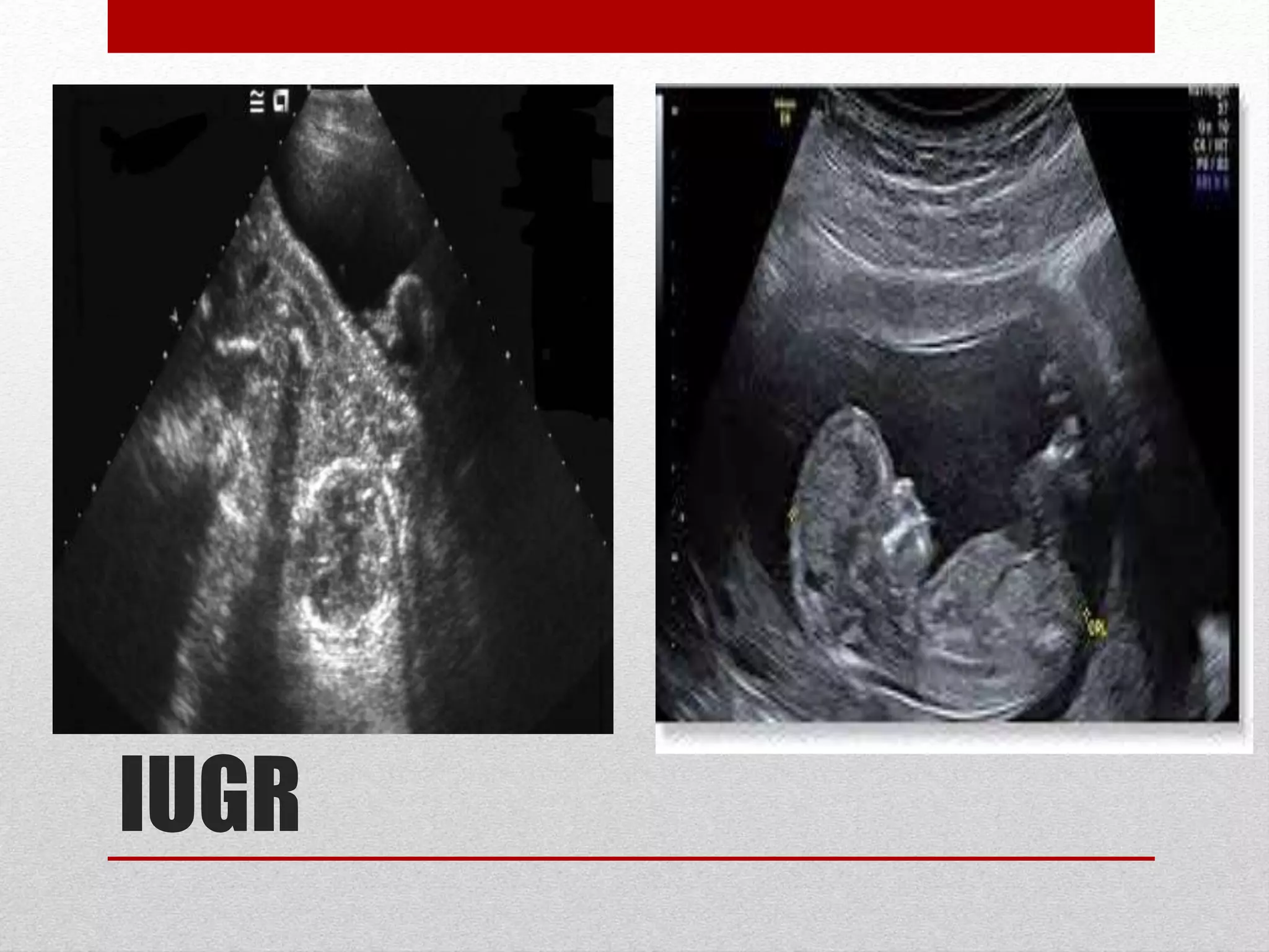 IUGR | PPT