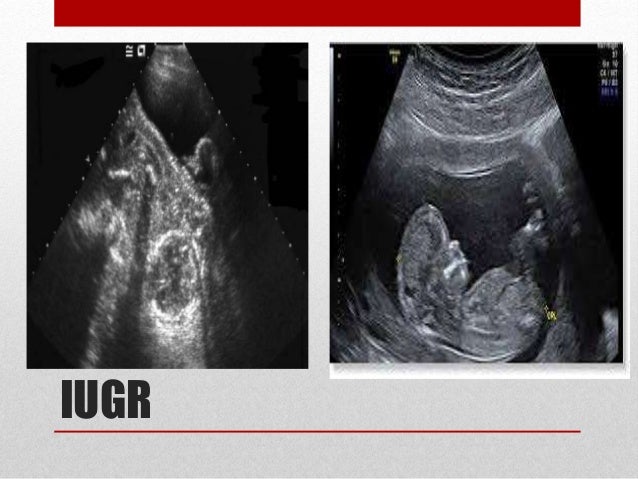 IUGR