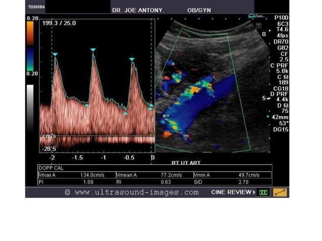 Intrauterine growth retardation (IUGR) | PPTX | Pregnancy ...