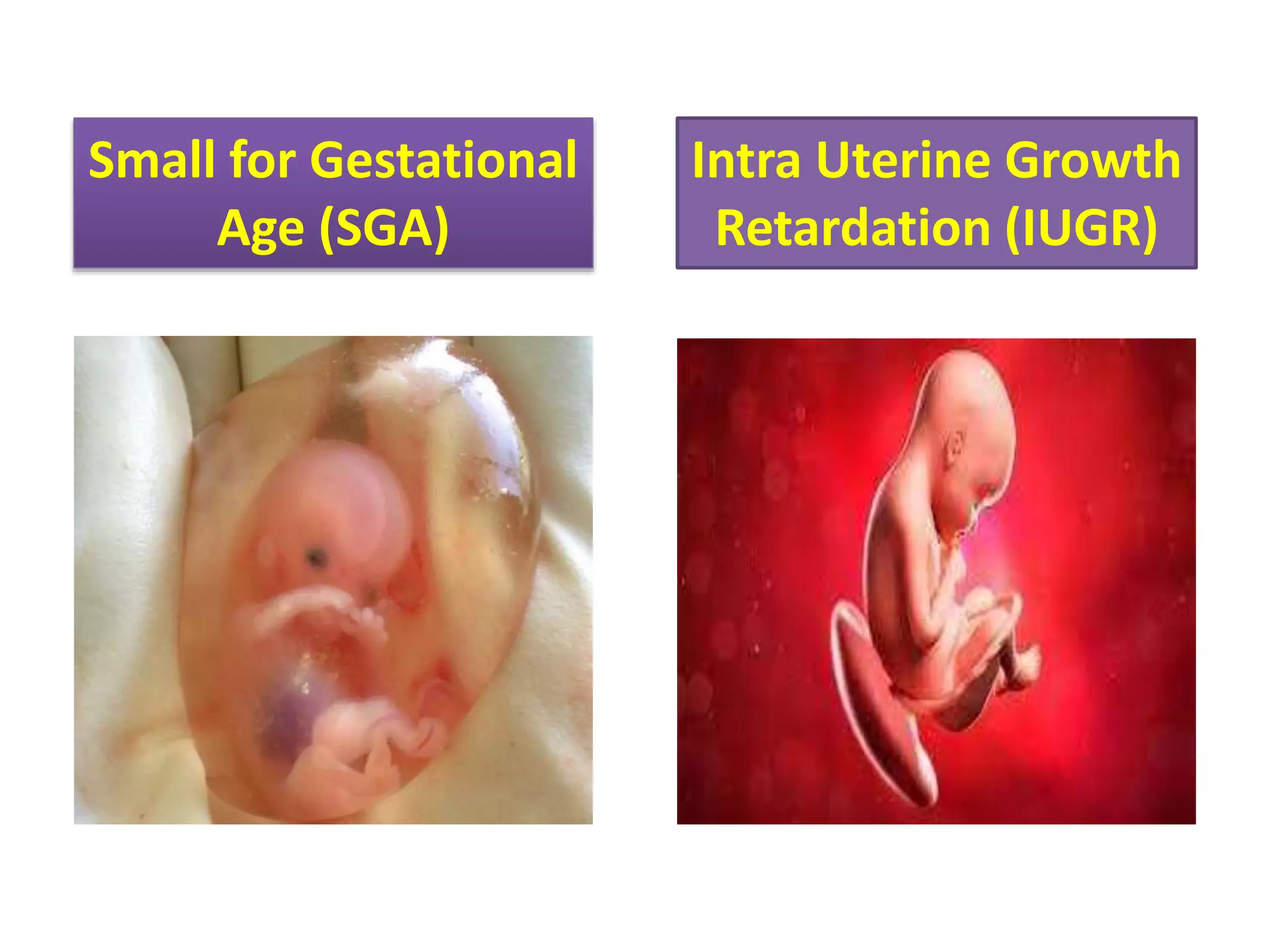 IUGR.pptx