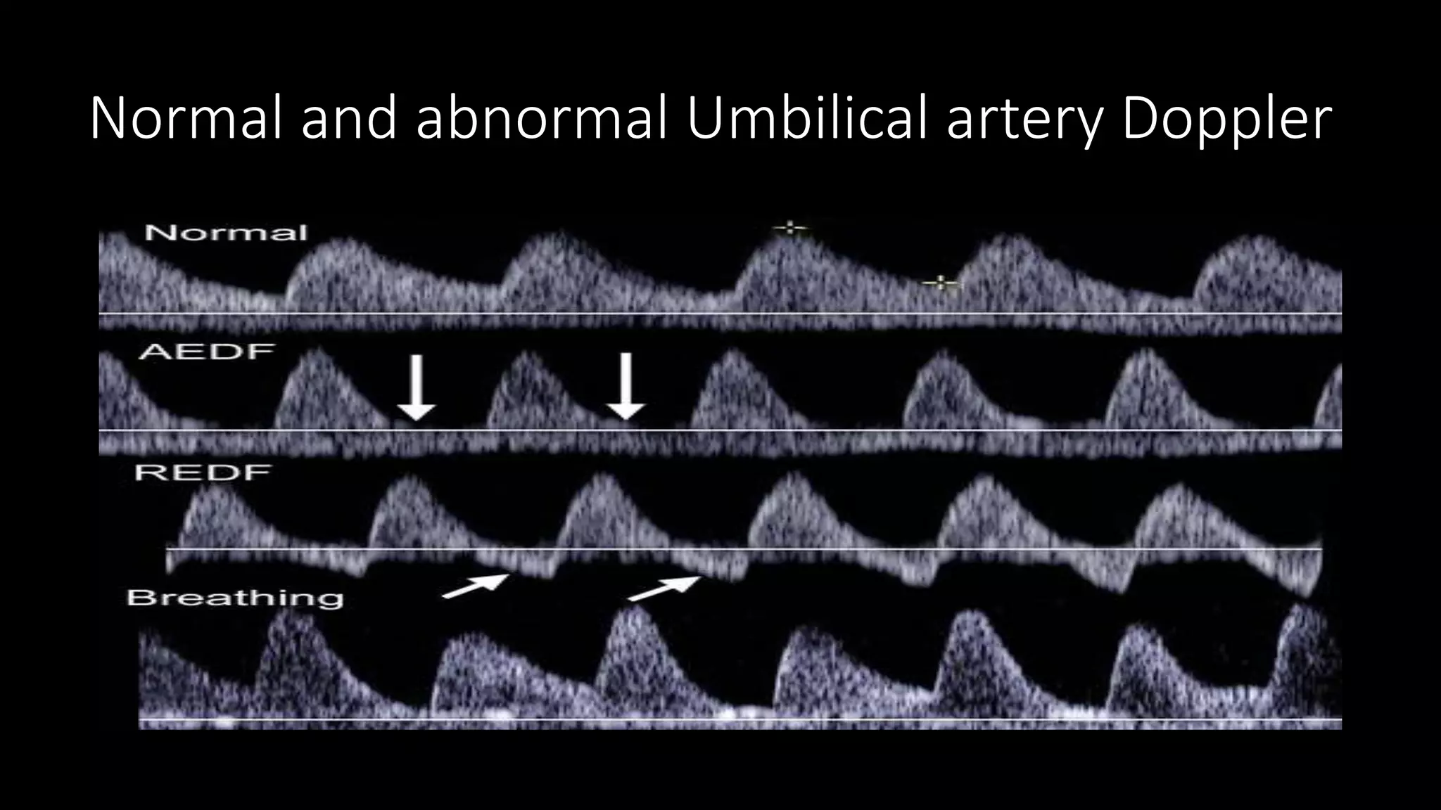 Fetal Doppler Evaluation | PPTX
