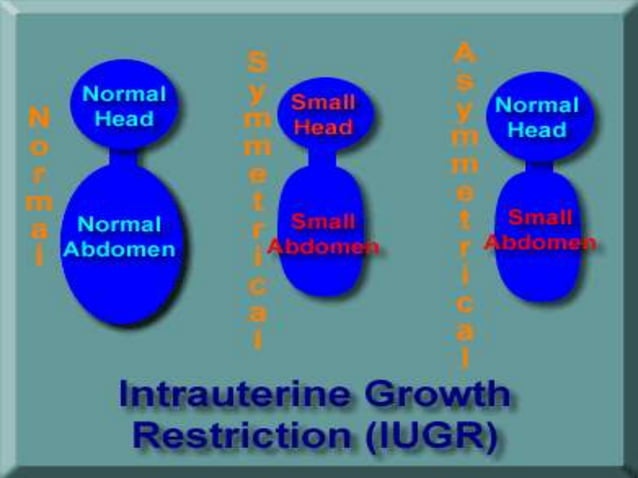 INTRA UTERINE GROWTH RETARDATION | PPTX | Pregnancy | Reproductive Health