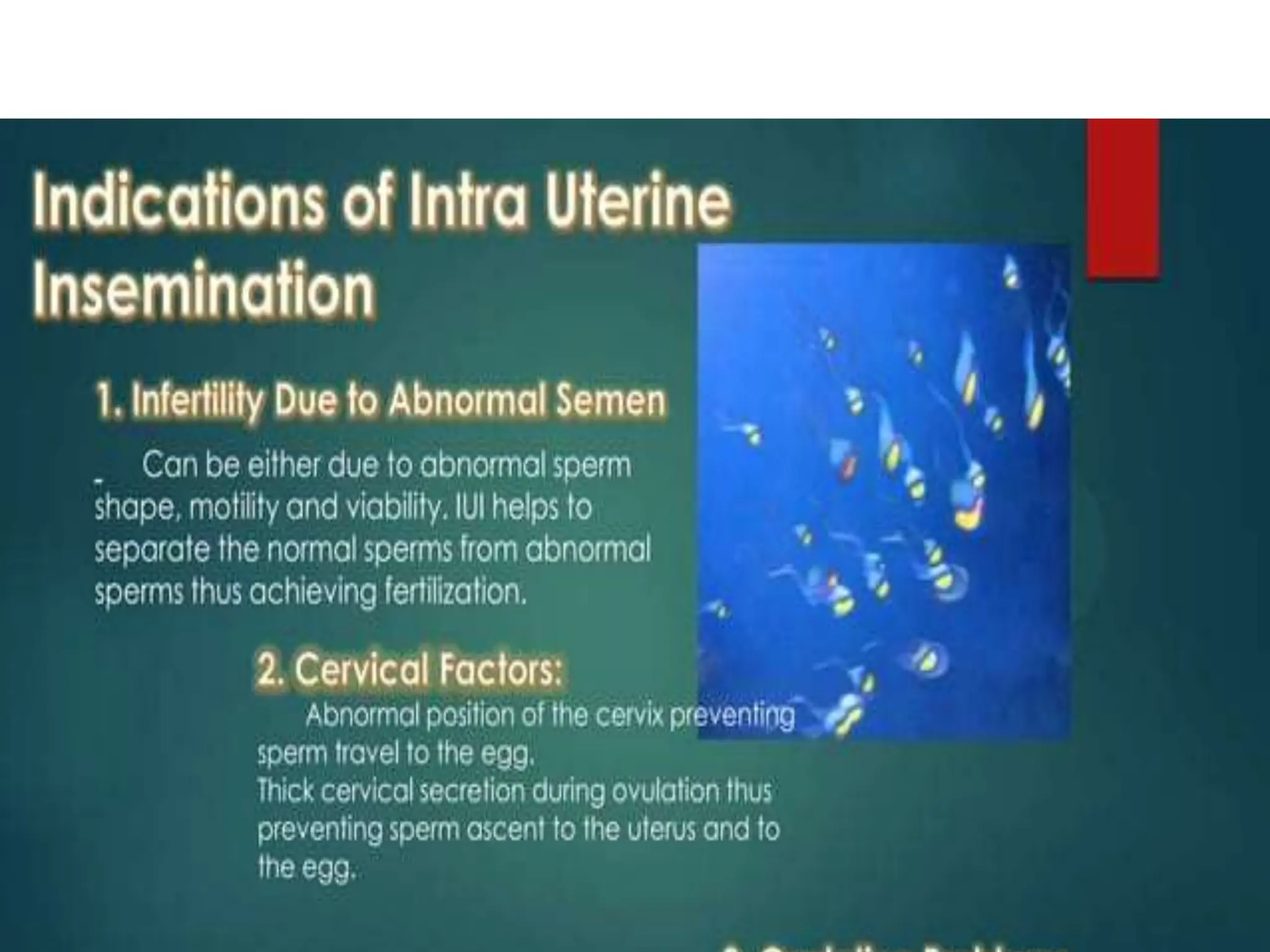 Intra uterine insemination (IUI) Indication | PPTX