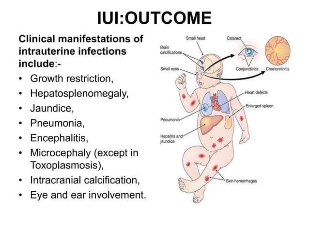 Intrauterine Infections- Dr RAVINDRA G O | PPTX | Pregnancy ...