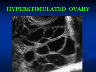 Intra uterine insemination (IUI) to Invitro Fertilization (IVF): When ...