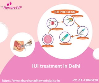 IUI treatment in Delhi.pdf