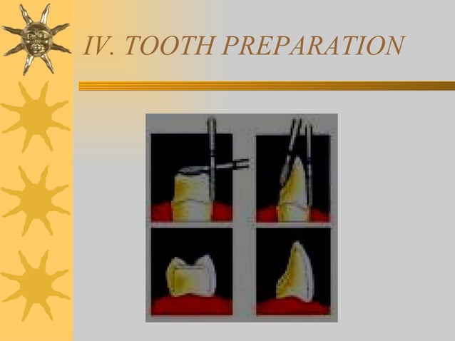 Iv.tooth prep v. occlusion | PPT